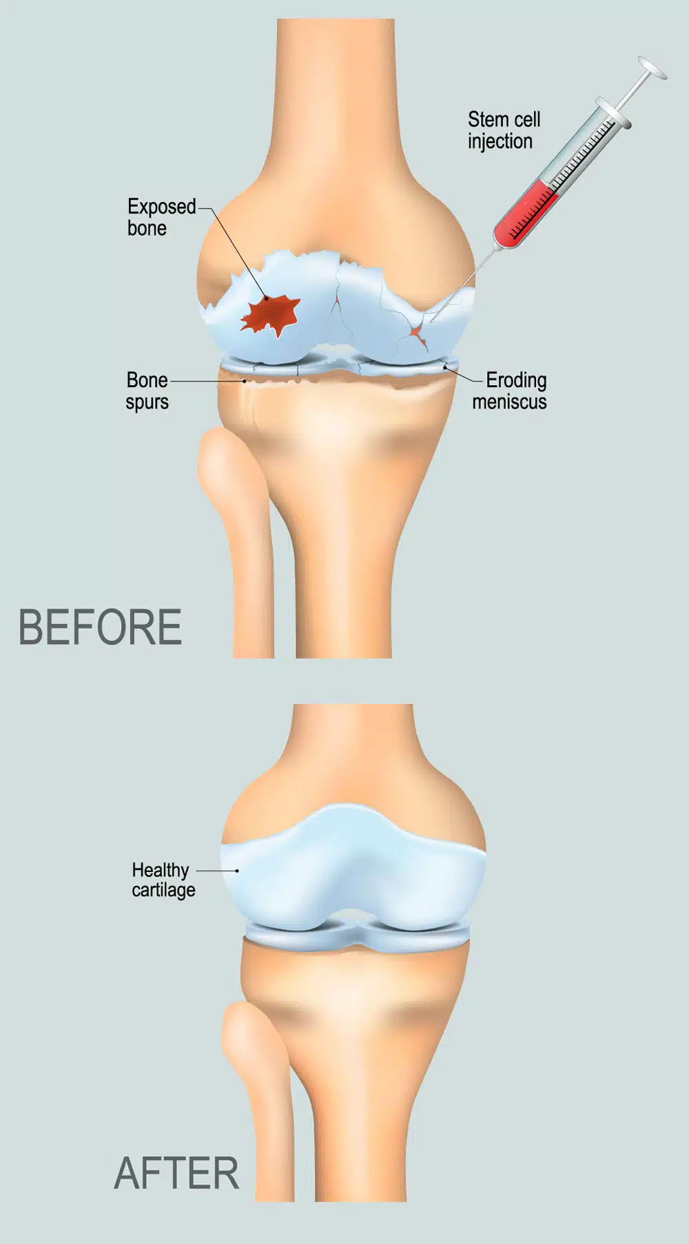 Stem Cell Injections – Natural Healing & Pain Relief