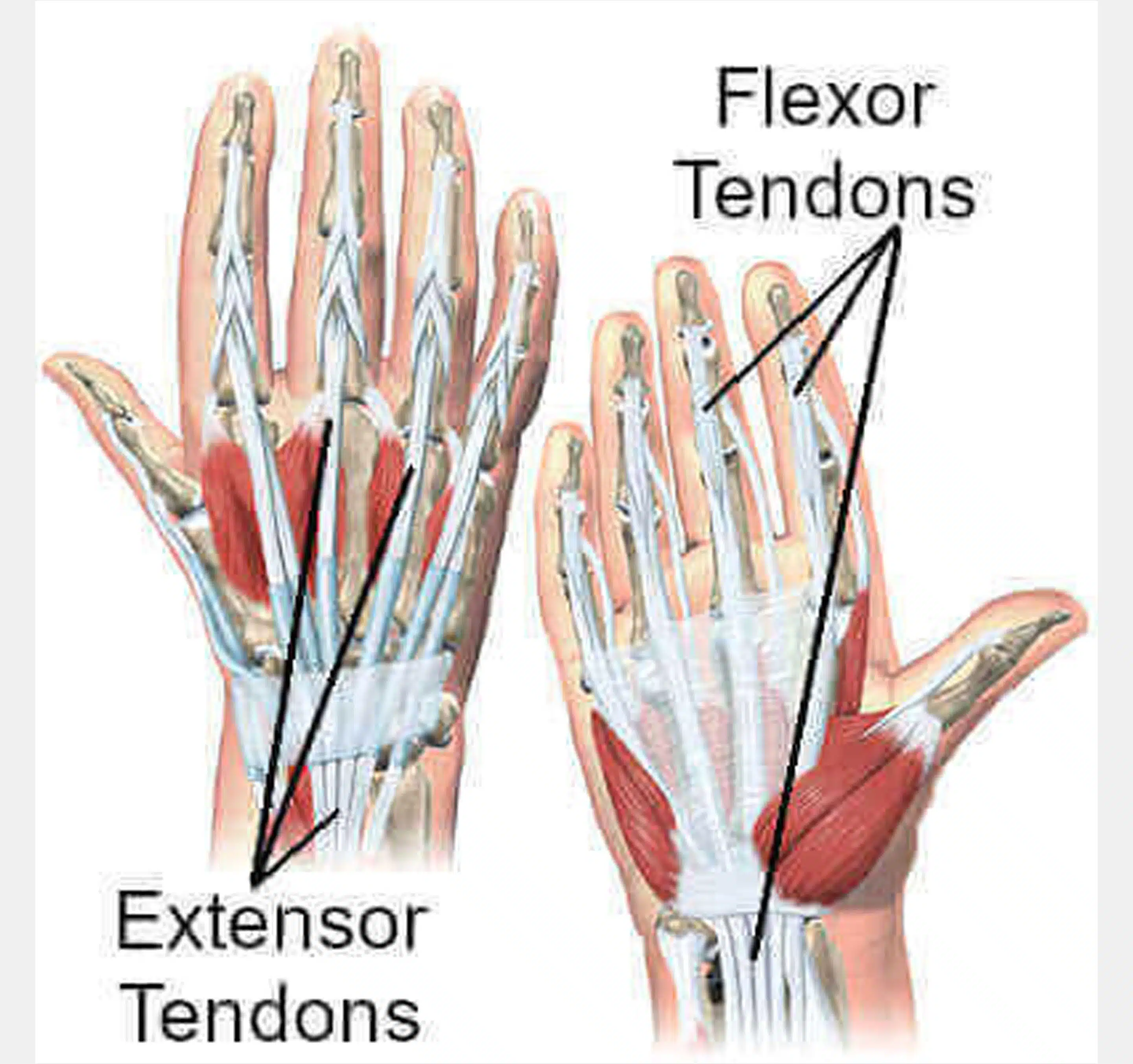 Hand Tendonitis Treatment in Florida